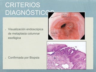 Esófago de Barret | PPTX