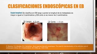 Esofago de Barret Criterios..pptx