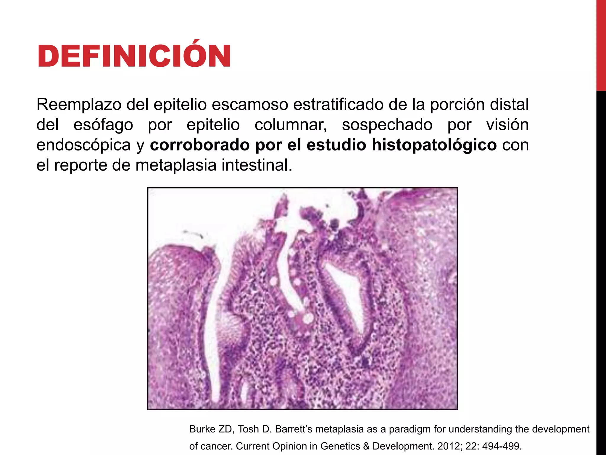 esofagodebarretfinal-180503061821 (1).pdf
