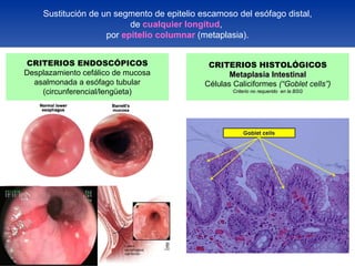 Esofago de barrett (f. gallardo) | PPT