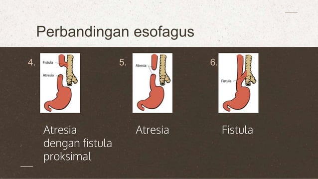 Esofagografi pada Atresia Esofagus (Tinjauan Pustaka) Matthew ...