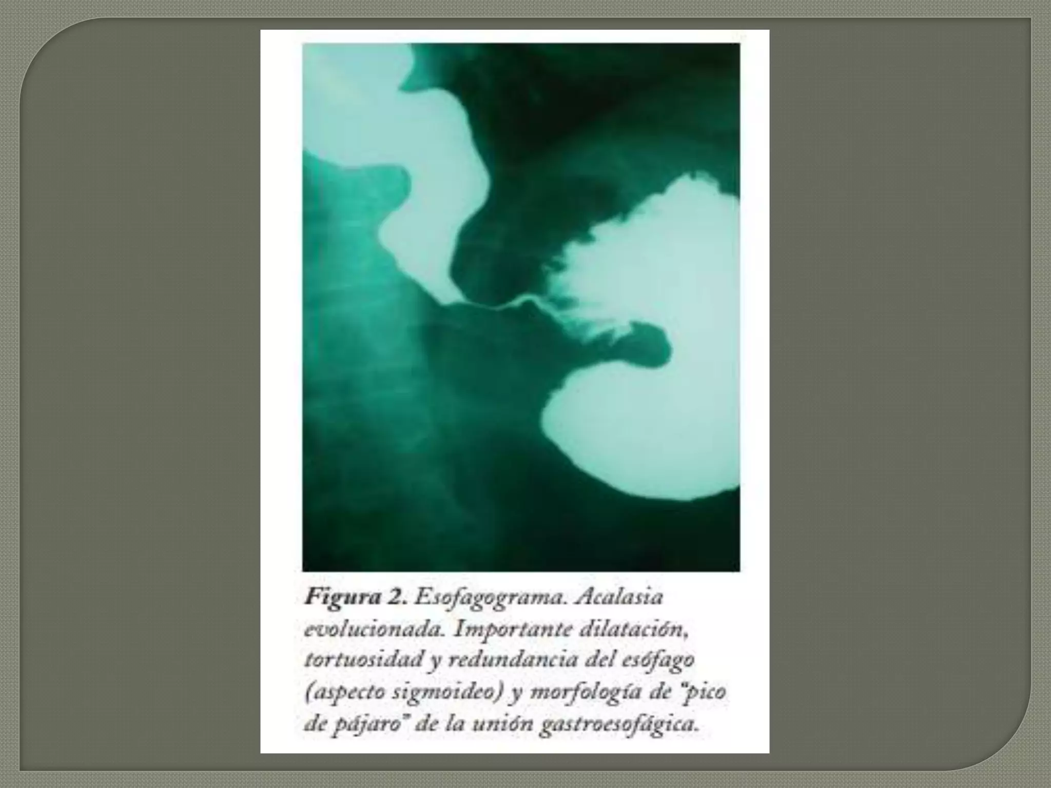 Esofagograma y Anatomía (Radiología Convencional) | PPTX