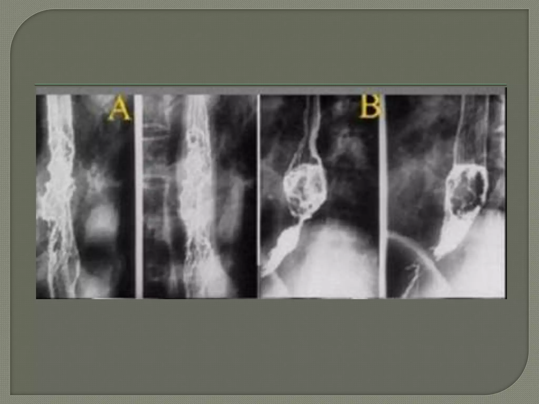 Esofagograma y Anatomía (Radiología Convencional) | PPTX