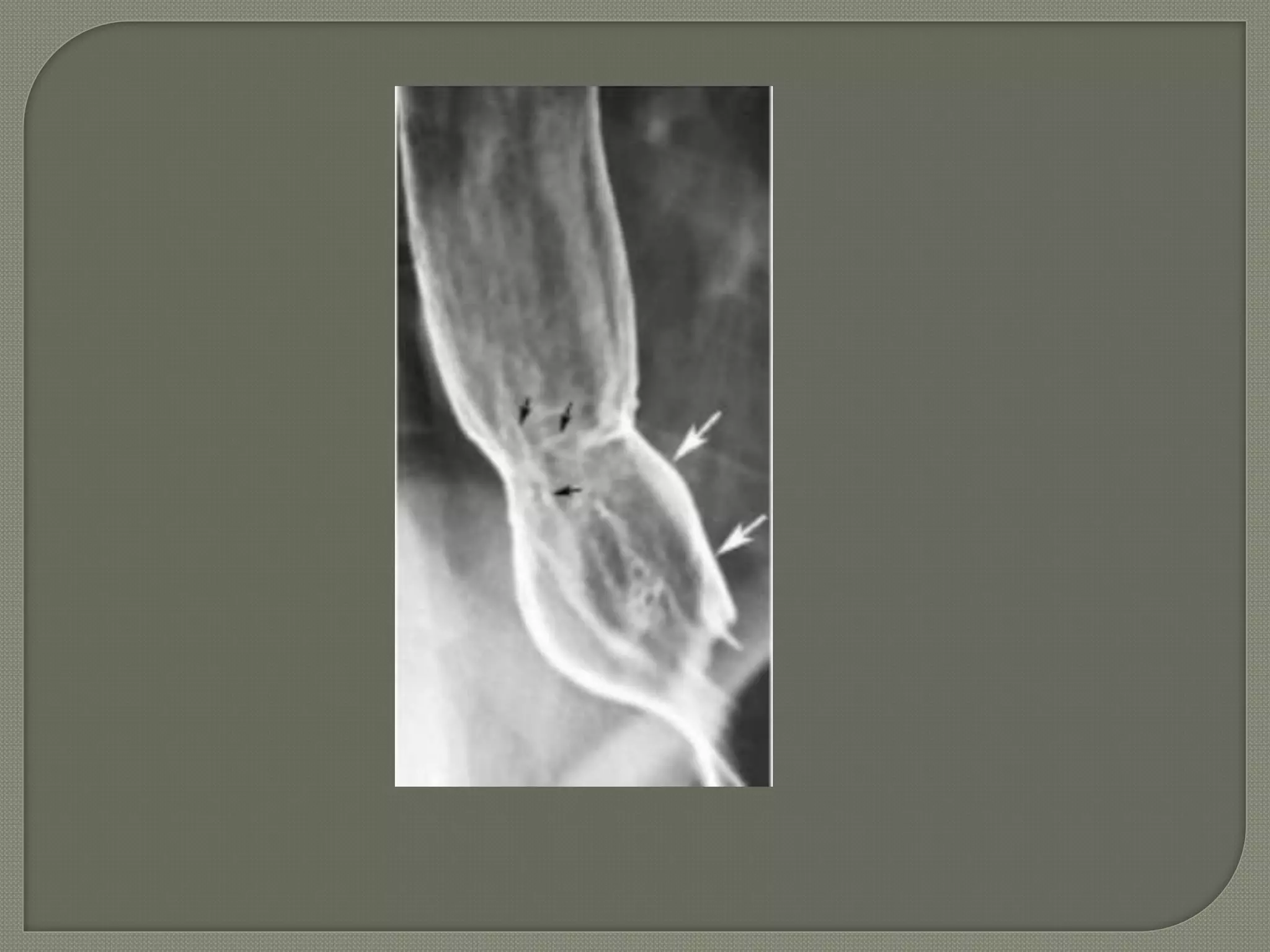 Esofagograma y Anatomía (Radiología Convencional) | PPTX