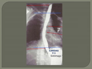 Esofagograma y Anatomía (Radiología Convencional) | PPTX