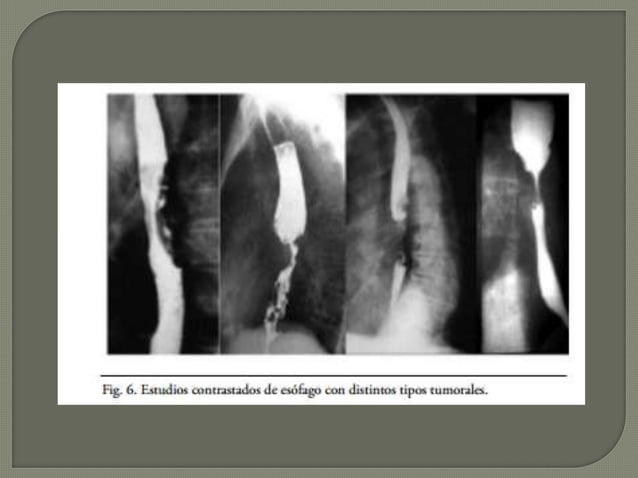 Esofagograma y Anatomía (Radiología Convencional)
