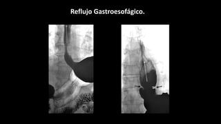 Esofagograma.pptx