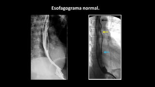 Esofagograma.pptx