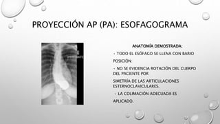 Esofagograma (bs) | PPTX