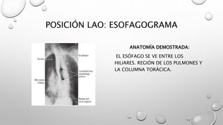 Esofagograma (bs) | PPTX