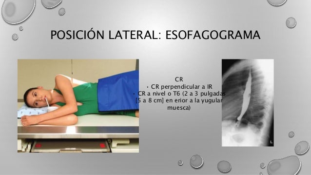 Esofagograma (bs)