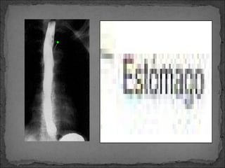 Esofagograma | PPT