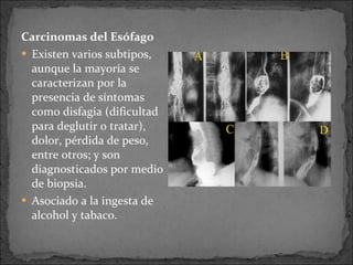 Esofagograma | PPT