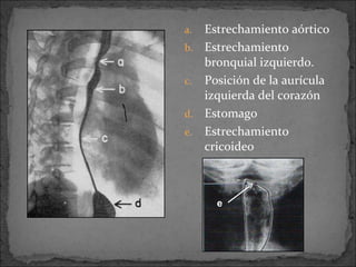 Esofagograma | PPT