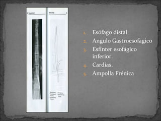 Esofagograma | PPT