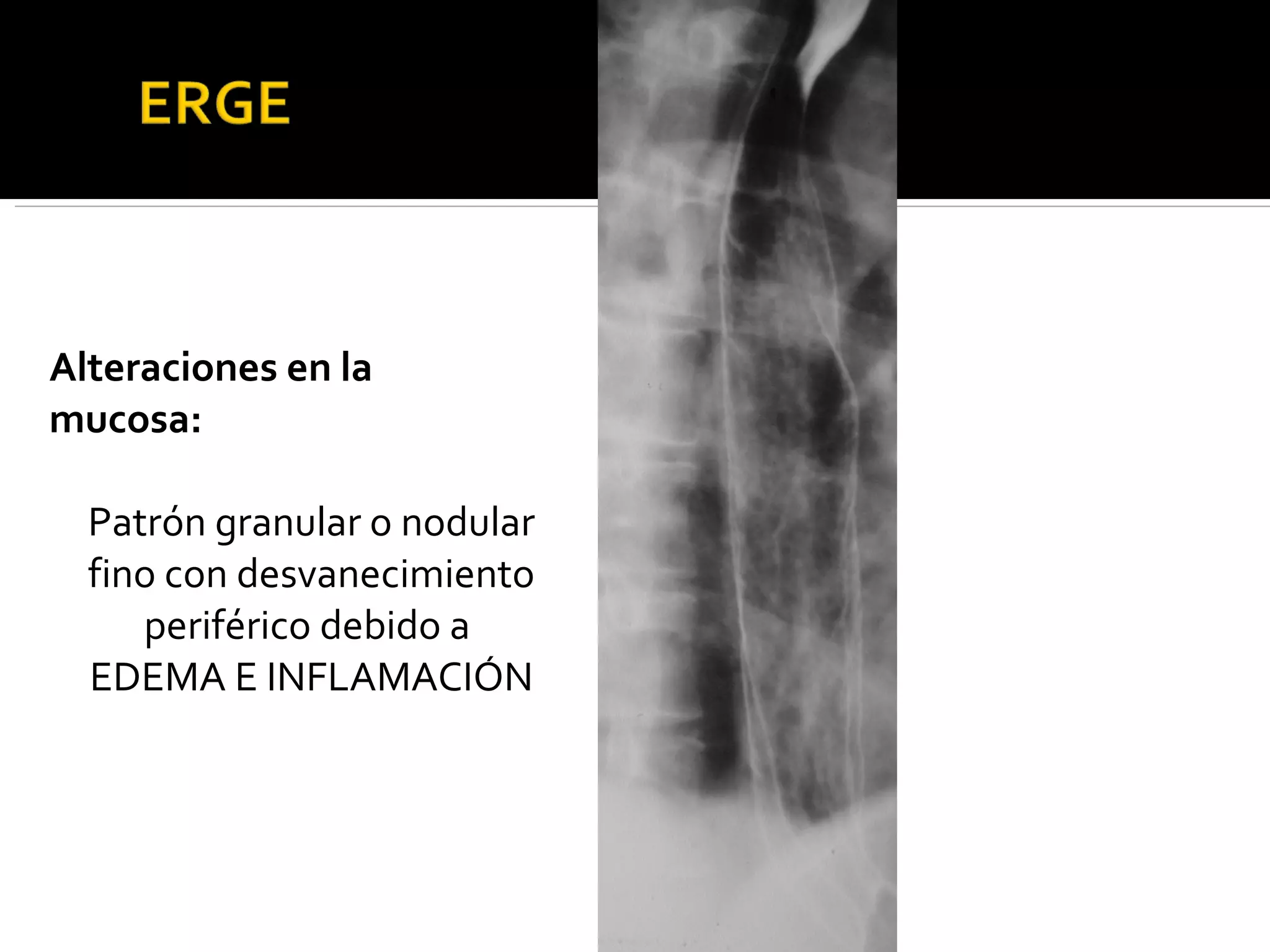 Esofagograma | PPT