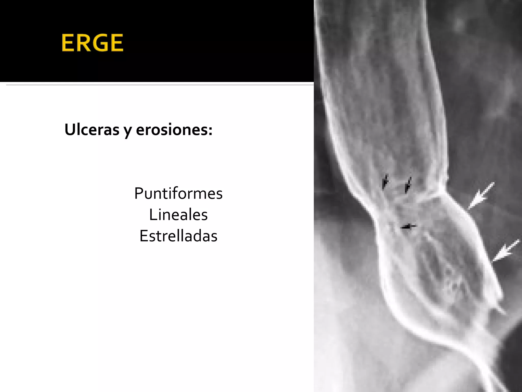 Esofagograma | PPT