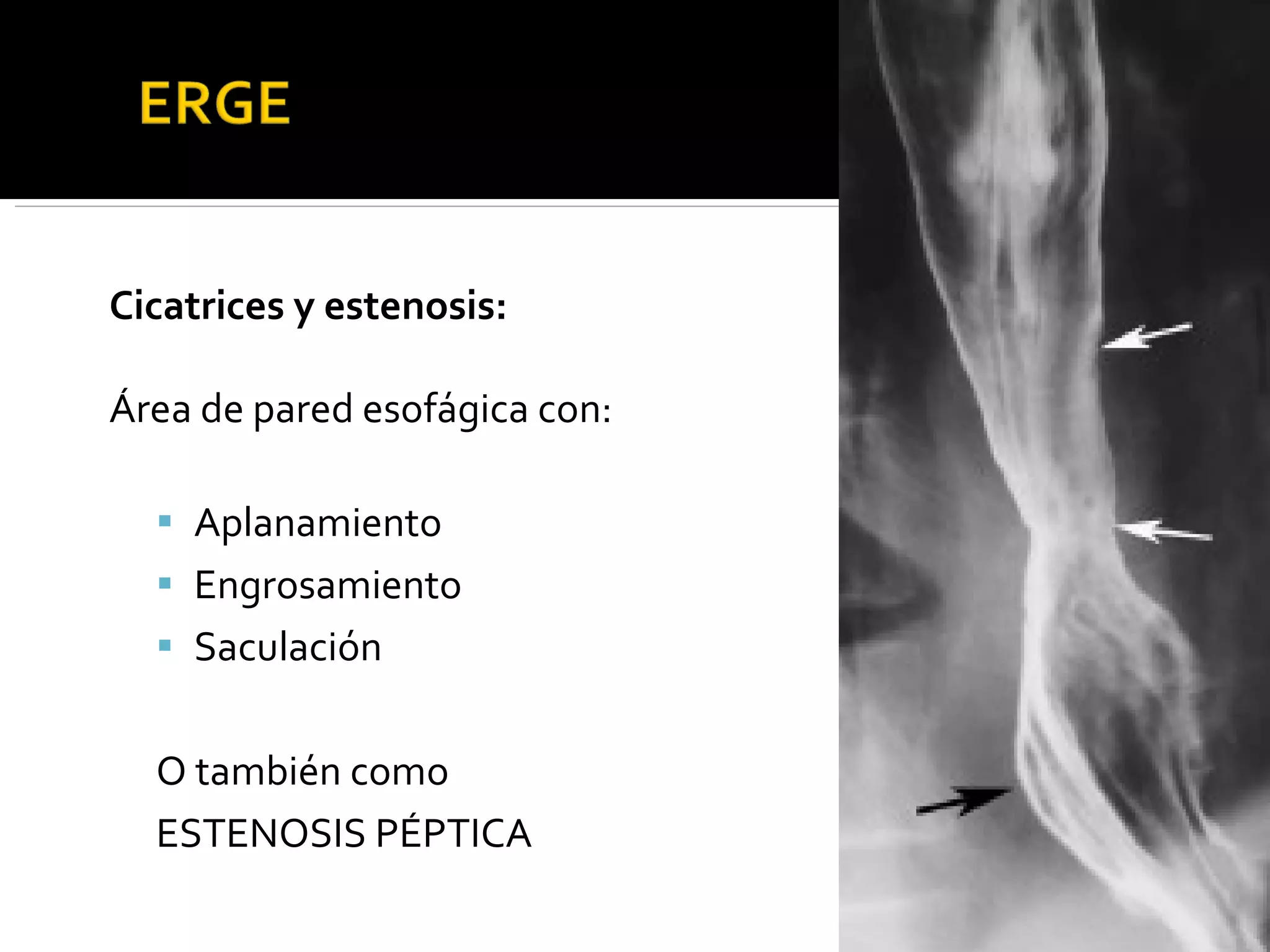 Esofagograma | PPT