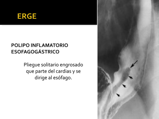 Esofagograma | PPT