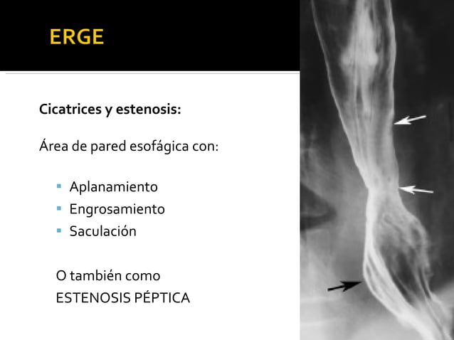 Esofagograma | PPT