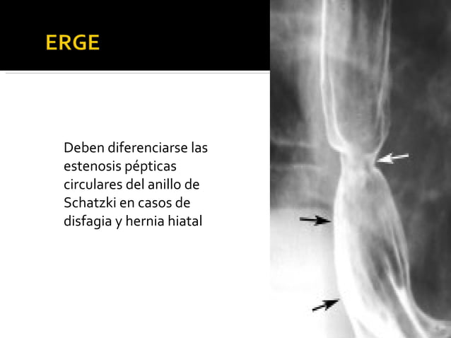 Esofagograma | PPT