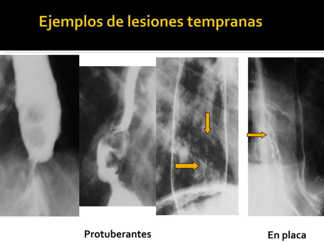 Esofagograma | PPT