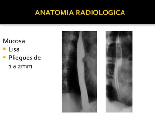 Esofagograma | PPT
