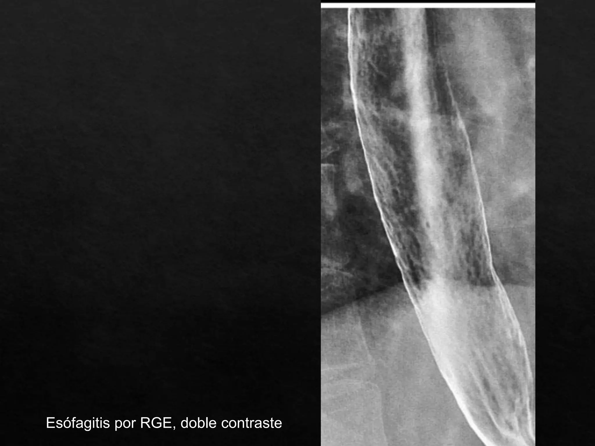 Esofagograma: trastornos anátomicos en radiología. | PDF