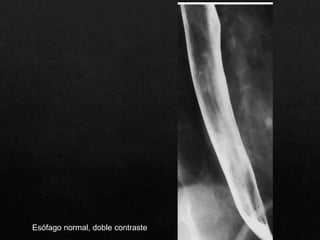 Esofagograma: trastornos anátomicos en radiología. | PDF