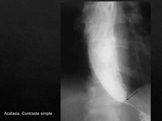 Esofagograma: trastornos anátomicos en radiología. | PDF