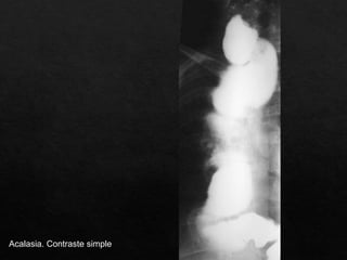Esofagograma: trastornos anátomicos en radiología. | PDF