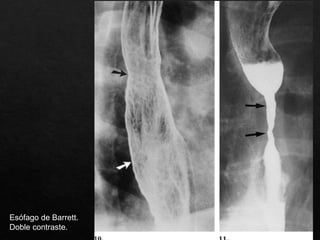 Esofagograma: trastornos anátomicos en radiología. | PDF