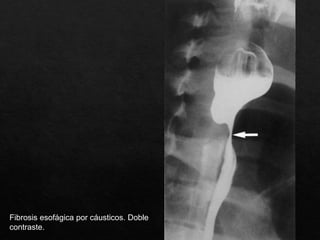 Esofagograma: trastornos anátomicos en radiología. | PDF