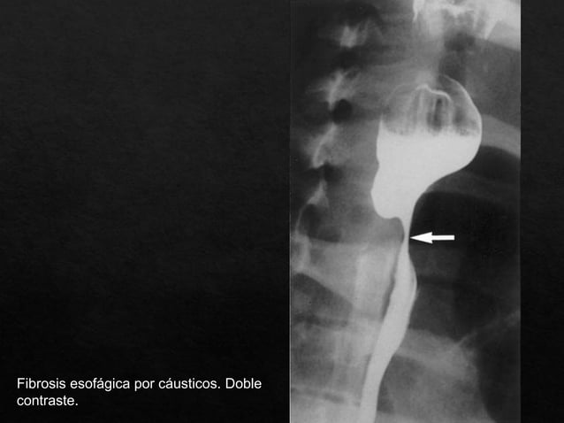 Esofagograma: trastornos anátomicos en radiología. | PDF