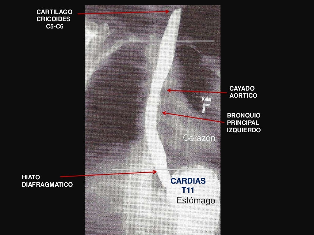 Esofagograma: trastornos anátomicos en radiología.