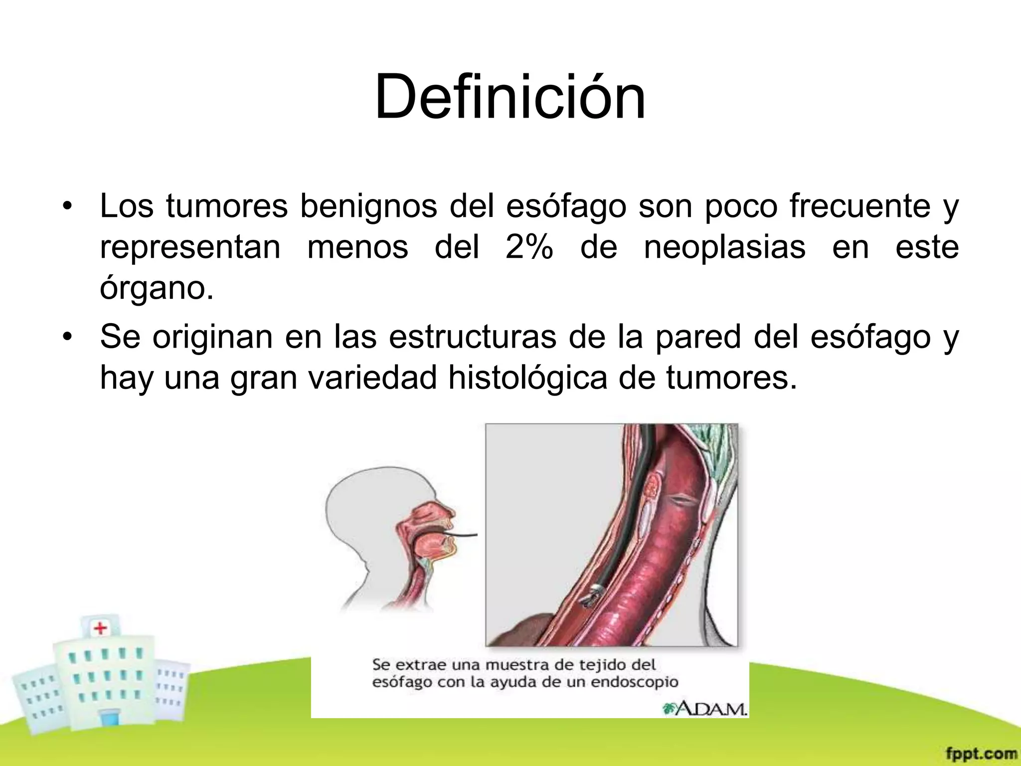 Esofago neoplasias | PPT