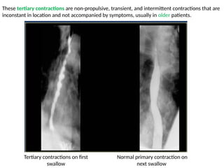 Esophageal motility disorder - Radiological imaging pptx | PPTX