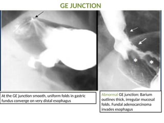 Esophageal motility disorder - Radiological imaging pptx | PPTX