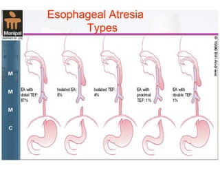 Esophageal atresia-- Epitome of modern surgery | PDF