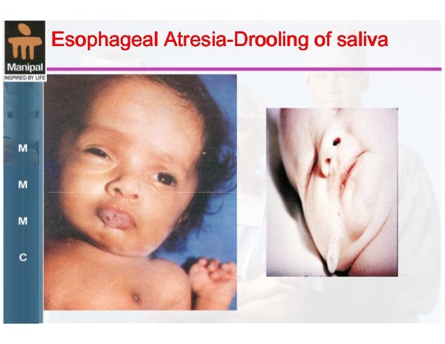 Esophageal atresia-- Epitome of modern surgery