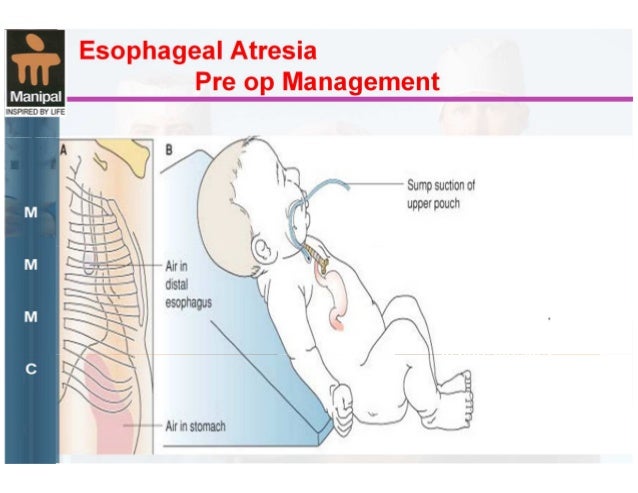 Esophageal atresia-- Epitome of modern surgery