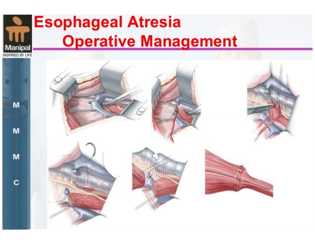 Esophageal atresia-- Epitome of modern surgery