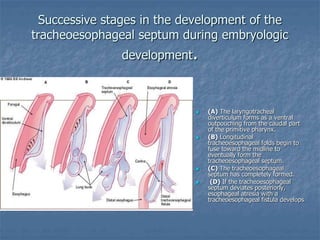 Esophageal Atresia.ppt