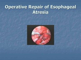 Esophageal Atresia.ppt