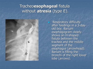 Esophageal Atresia.ppt