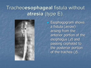Esophageal Atresia.ppt
