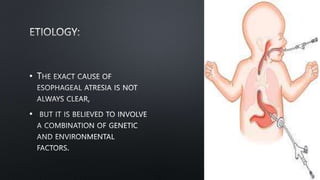 Esophageal atresia | PPTX