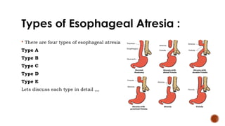 Esophageal Atresia. explaining different conditions and effects. | PPT