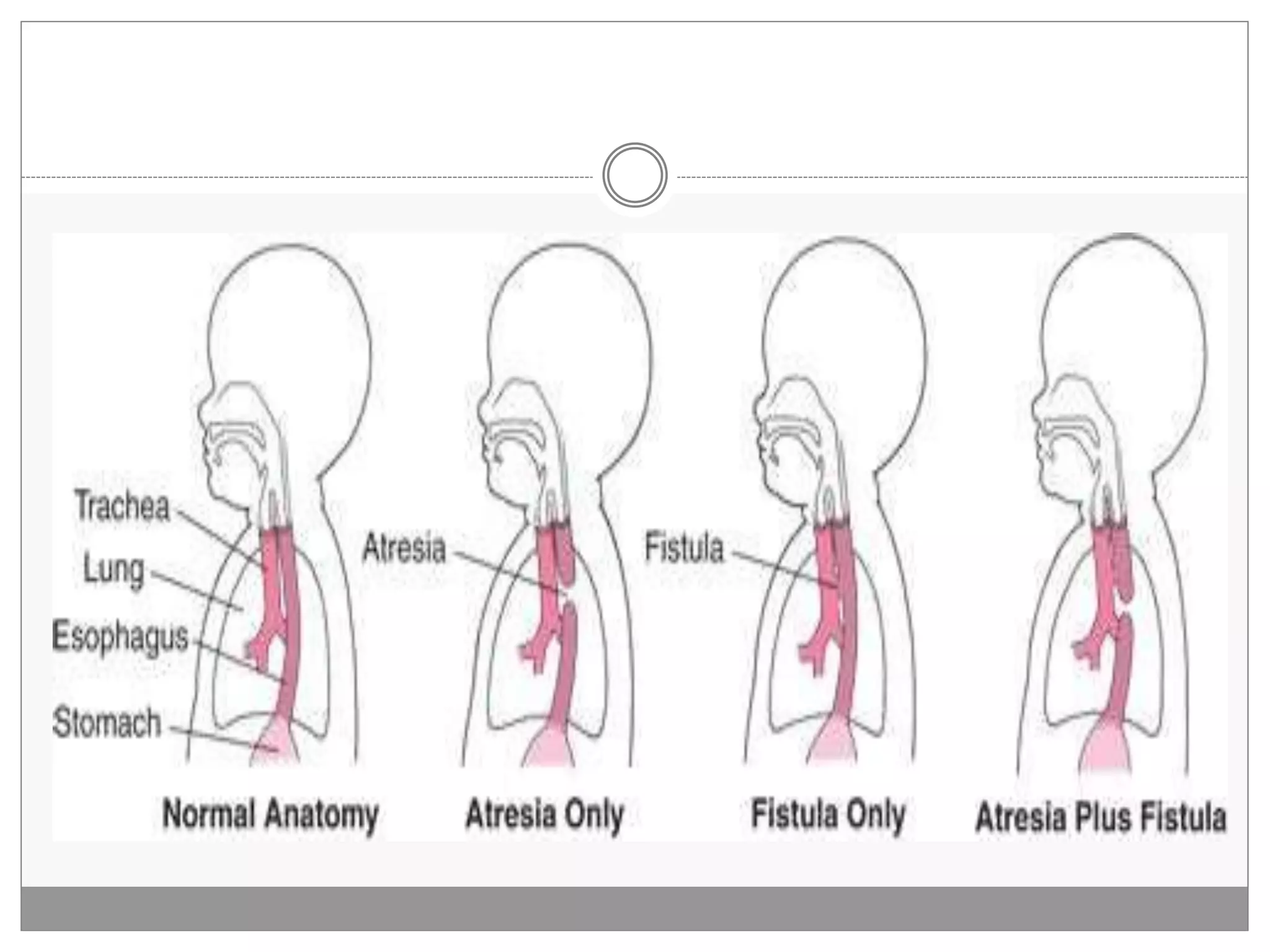 Esophageal atresia & tracheo-esophageal fistula | PPTX