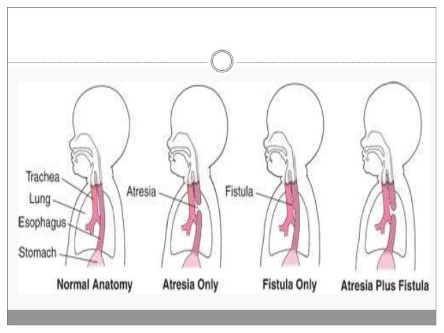 Tracheo oesophageal fistula – DR. TRYNAADH